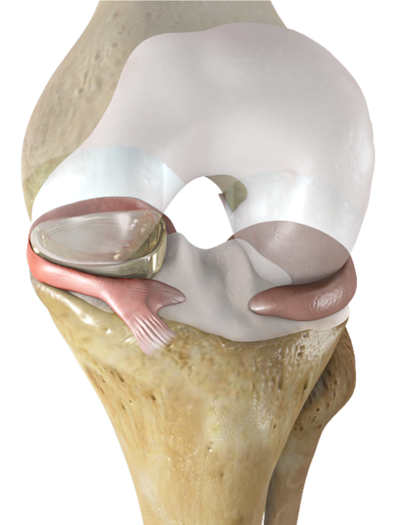 המיניסקוס המלאכותי הראשון - Rimoni Industries